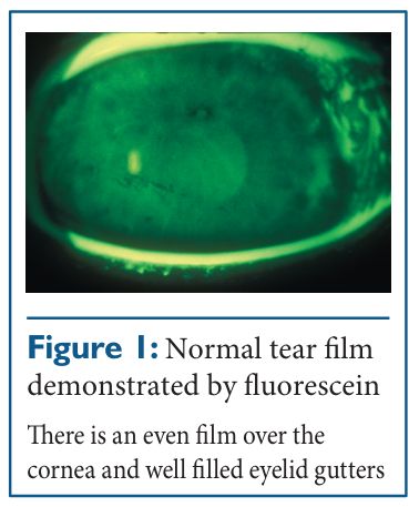 The dry eye: treatment and management