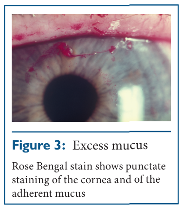 The dry eye: treatment and management