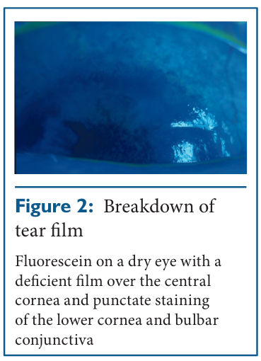 The dry eye: treatment and management