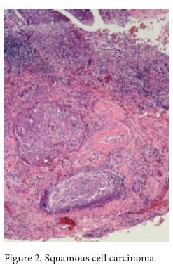 Management of skin cancer in older patients