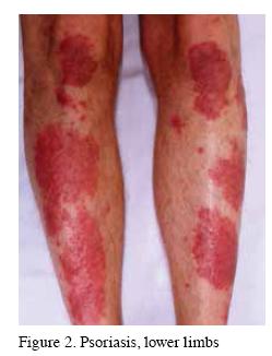 Skin conditions: An overview of rashes in the elderly