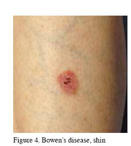 Skin conditions: An overview of rashes in the elderly