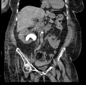 Staghorn calculus: beyond the long-term urinary catheter
