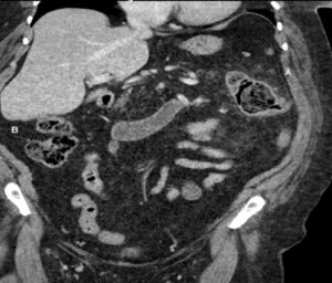 Case study: stercoral colitis: a rare but serious cause of abdominal ...