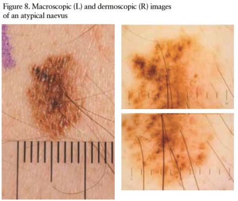 Melanocytic lesions and moles: management in primary care - Pavilion ...