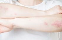 Managing common skin conditions in older people - Pavilion Health Today