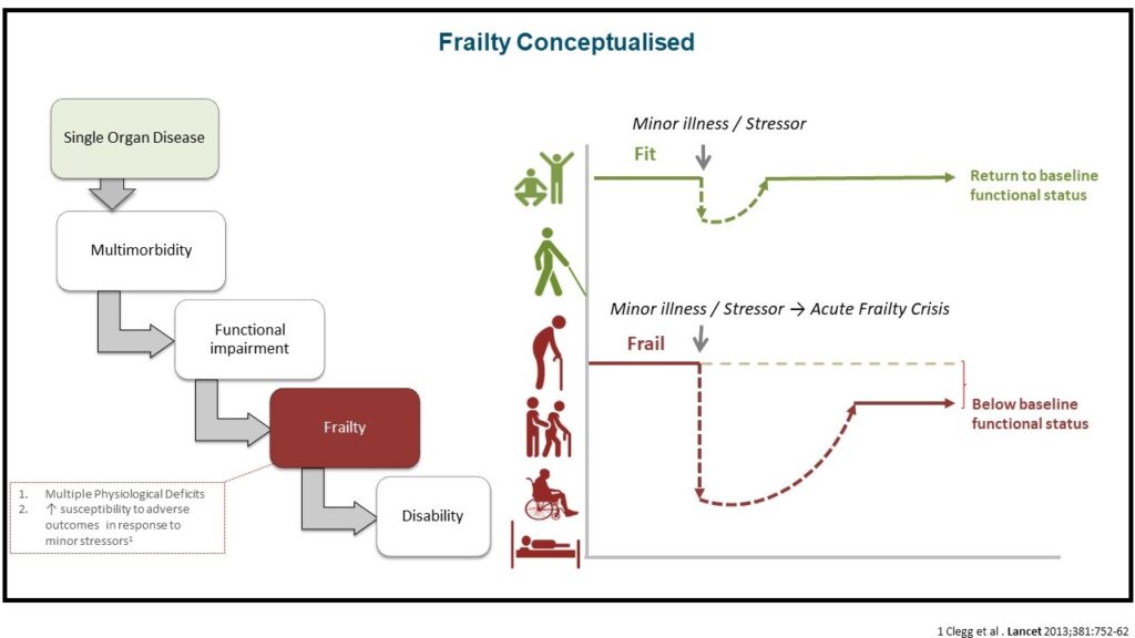 The role of nutrition in prevention and management of frailty ...