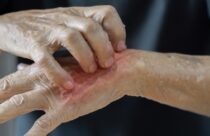 Skin conditions: An overview of rashes in the elderly