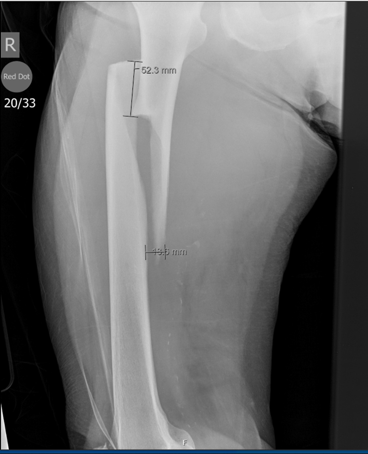 Case study: bisphosphonates and a tale of two femurs - Pavilion Health ...